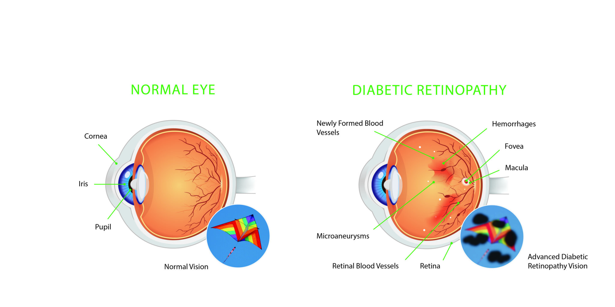 Diabetic Eye Exams • Latham Medical Group